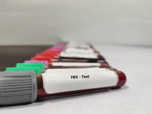 Everything On Fasting Blood Sugar Test (FBS Test) | Health-e